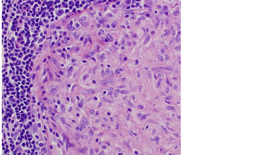 Tuberculous Olecranon Bursitis