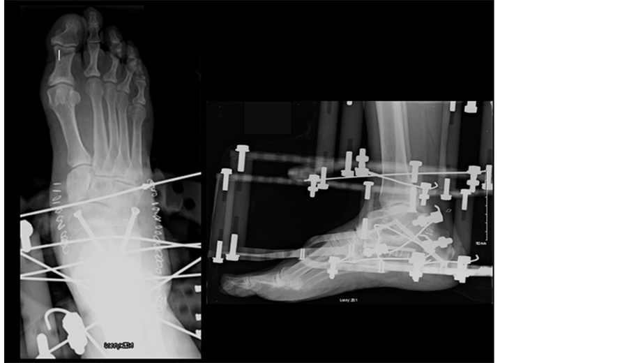 Triple Arthrodesis with Internal and External Fixation: Technique Paper