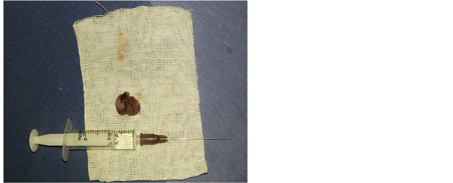 Pyogenic Granuloma of Nasal Septum: A Case Report and Review of Literature