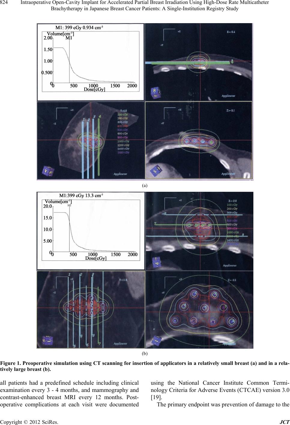 Intraoperative Open-Cavity Implant for Accelerated Partial Breast ...