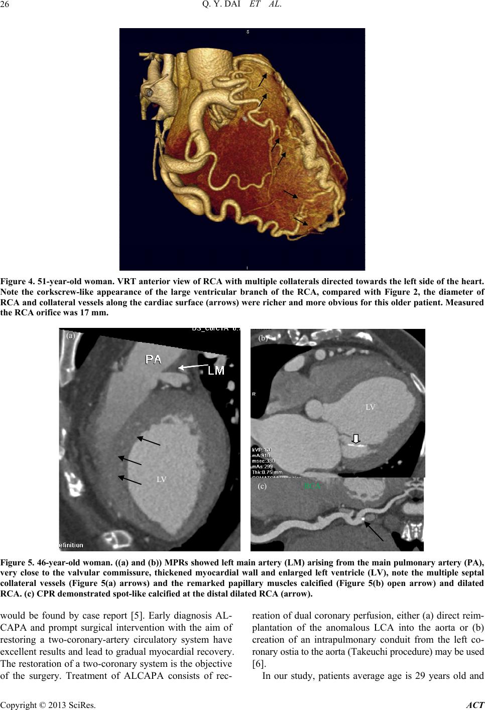 MDCT Angiography Imaging Presentation of ALCAPA in Adults