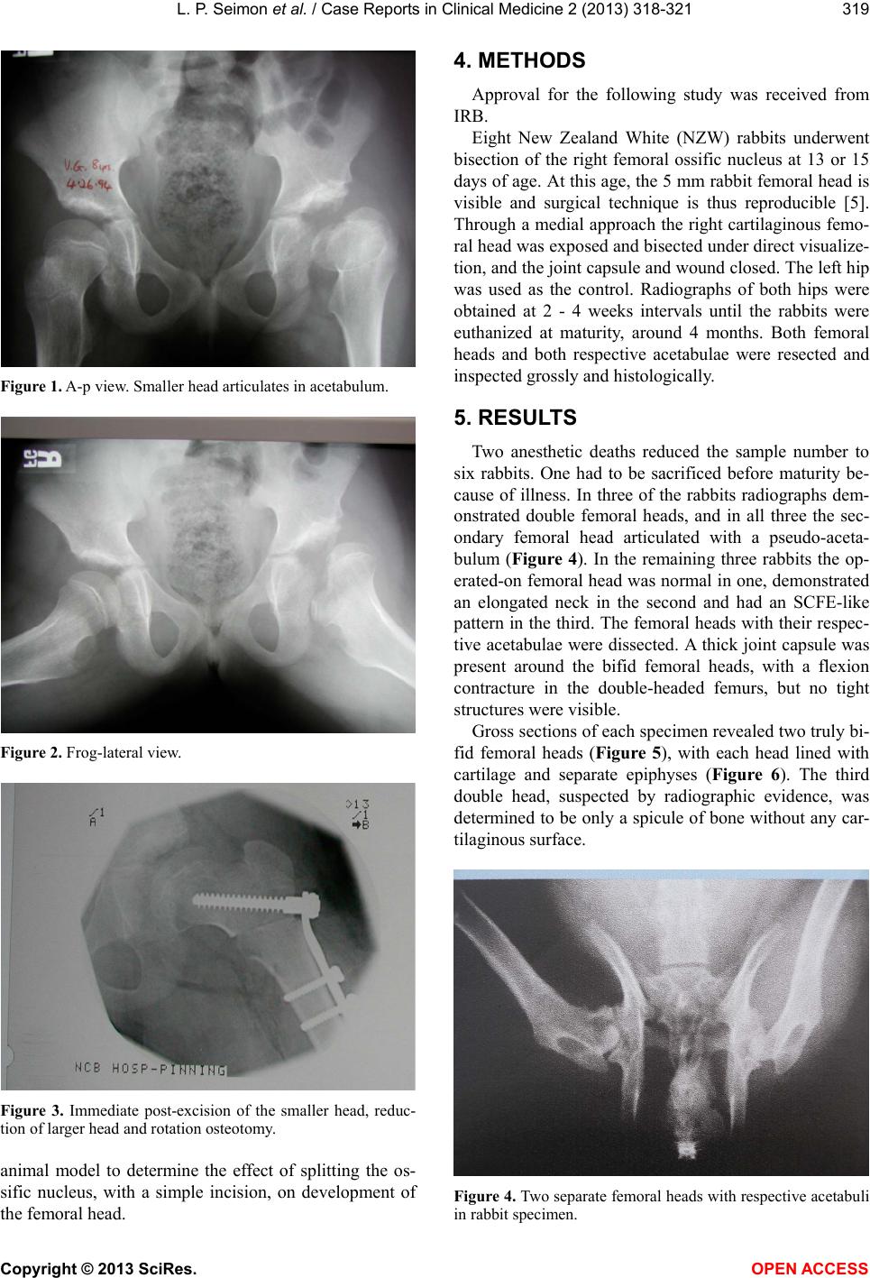 Etiology of the bifid (double) femoral head, with prior history of ...