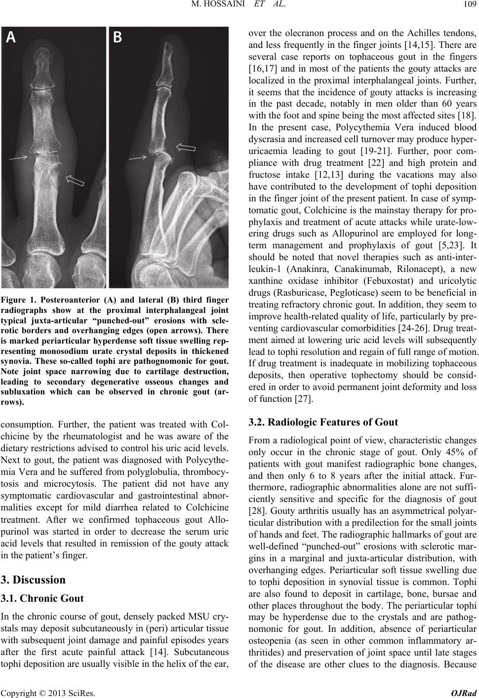 The Pathognomic Radiologic Features of Gout in the Fingers and Review ...