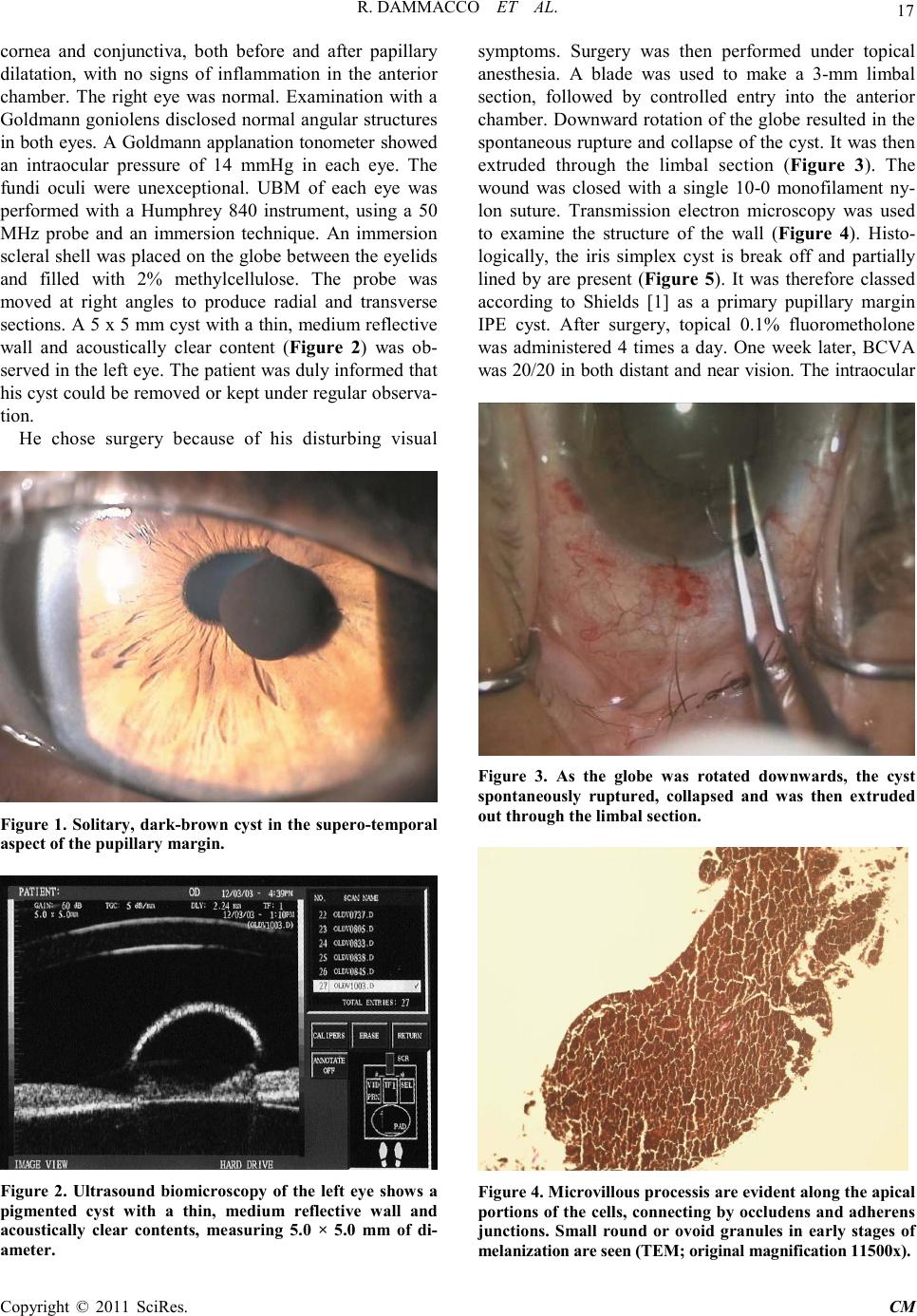 Primary Pupillary Margin Cyst of the Iris Pigment Epithelium