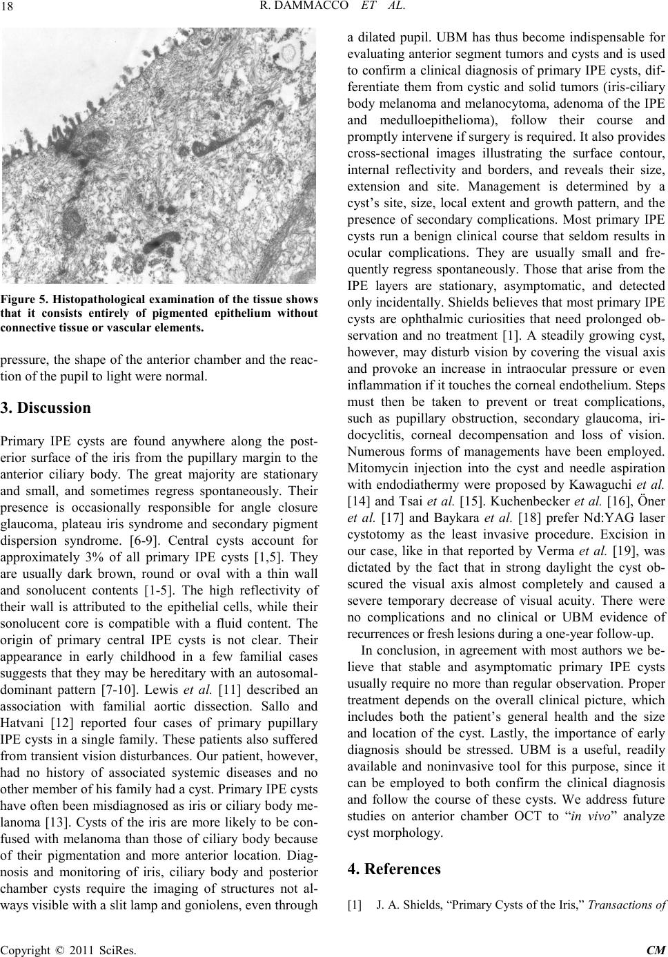 Primary Pupillary Margin Cyst of the Iris Pigment Epithelium