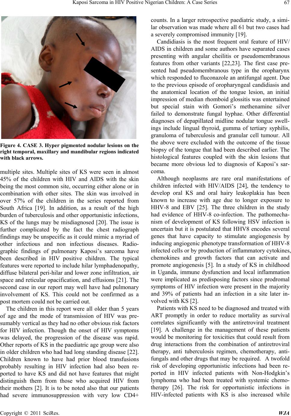 Kaposi Sarcoma in HIV Positive Nigerian Children: A Case Series