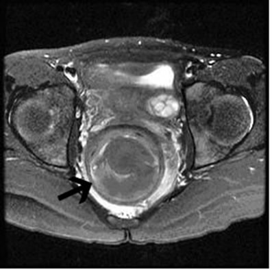 Rectal Duplication Cyst in a 12 year old Female Presenting with Chronic ...