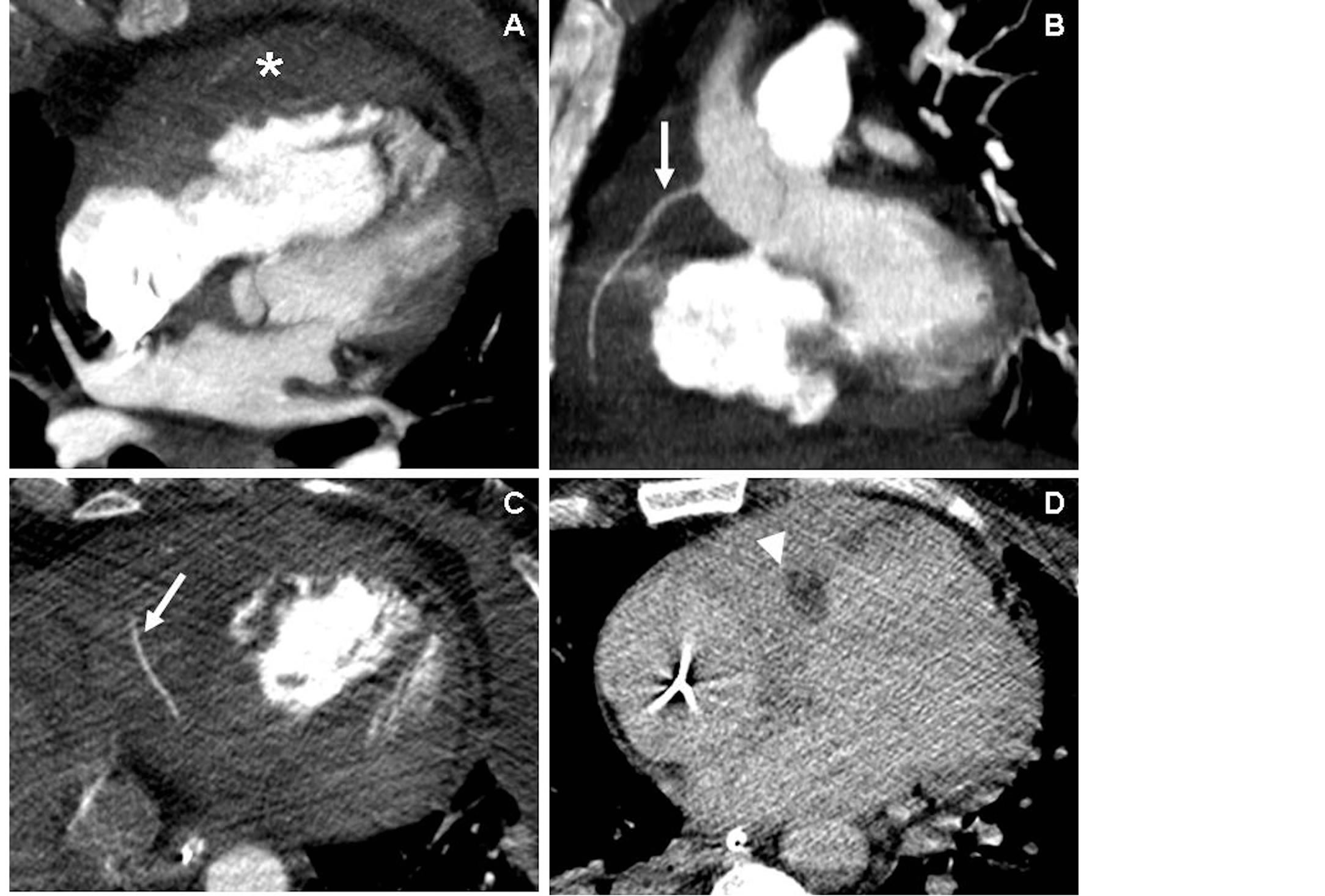 Cardiac Chloroma Clinically Resembling Pulmonary Embolism in the ...